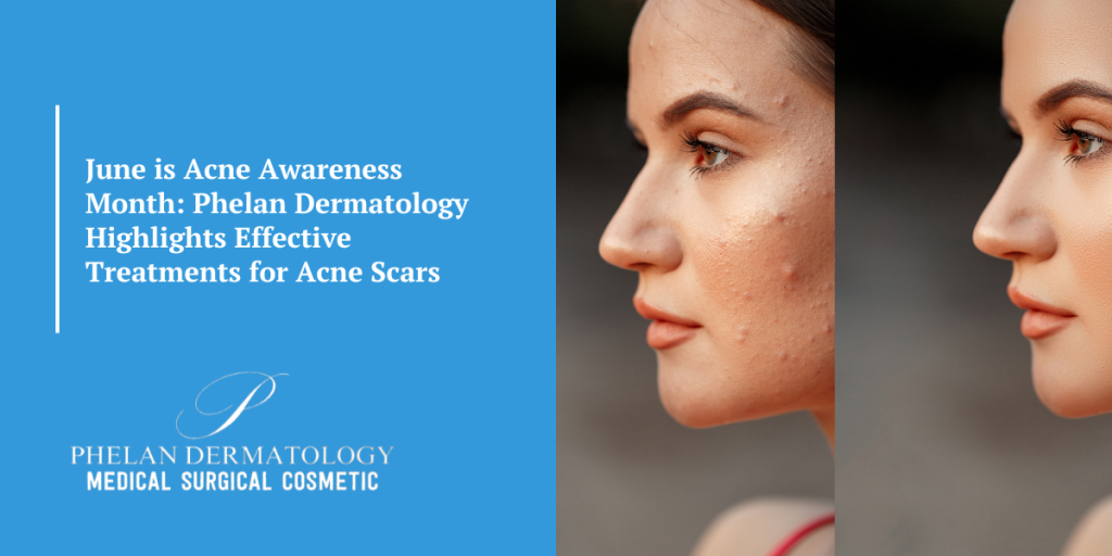 Phelan Dermatology Highlights Effective Treatments for Acne Scars for ...